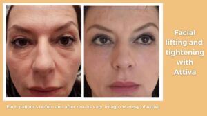 The ATTIVA Non-Surgical Facelift – Skin Tightening Centers